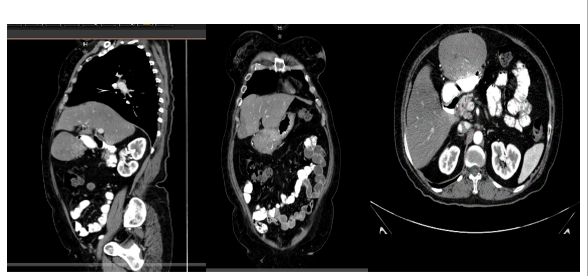 Tumores del estroma gastrointestinal en un Hospital de México | Moreno ...