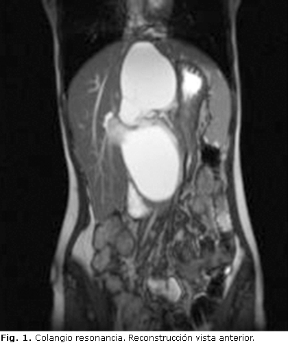 Quiste de colédoco gigante | González González | Revista Cubana de Cirugía