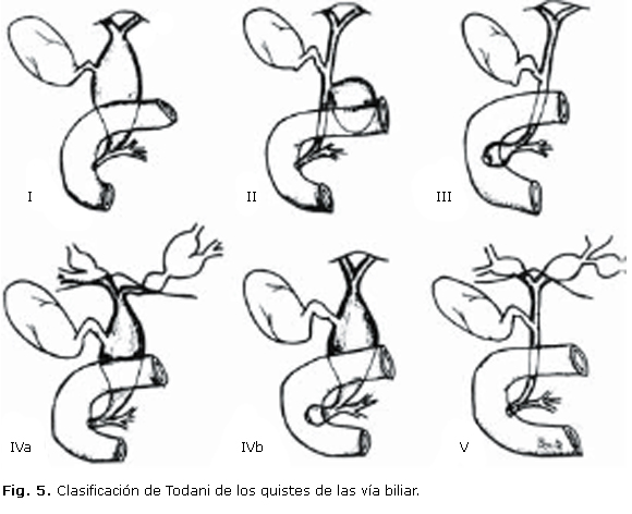 Quiste de colédoco gigante | González González | Revista Cubana de Cirugía