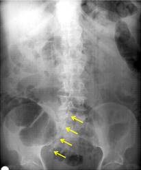 Perforación de sigma secundaria a migración de prótesis biliar | Ponce ...
